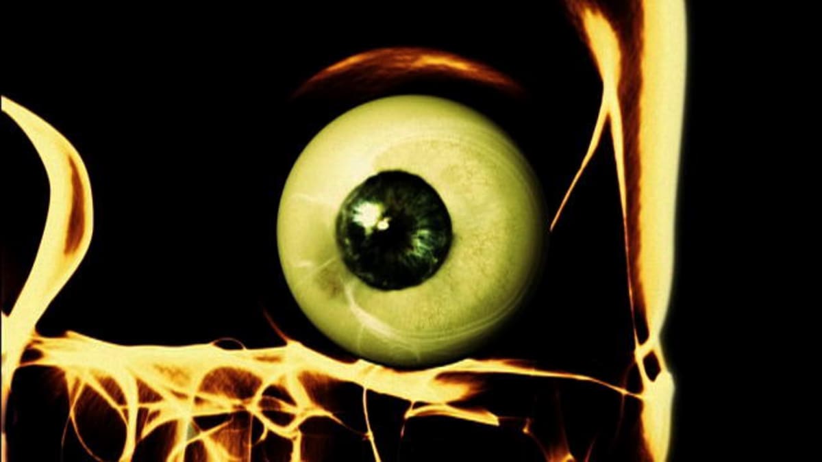 Parasites Invade Eyeball - Monsters Inside Me | Animal Planet